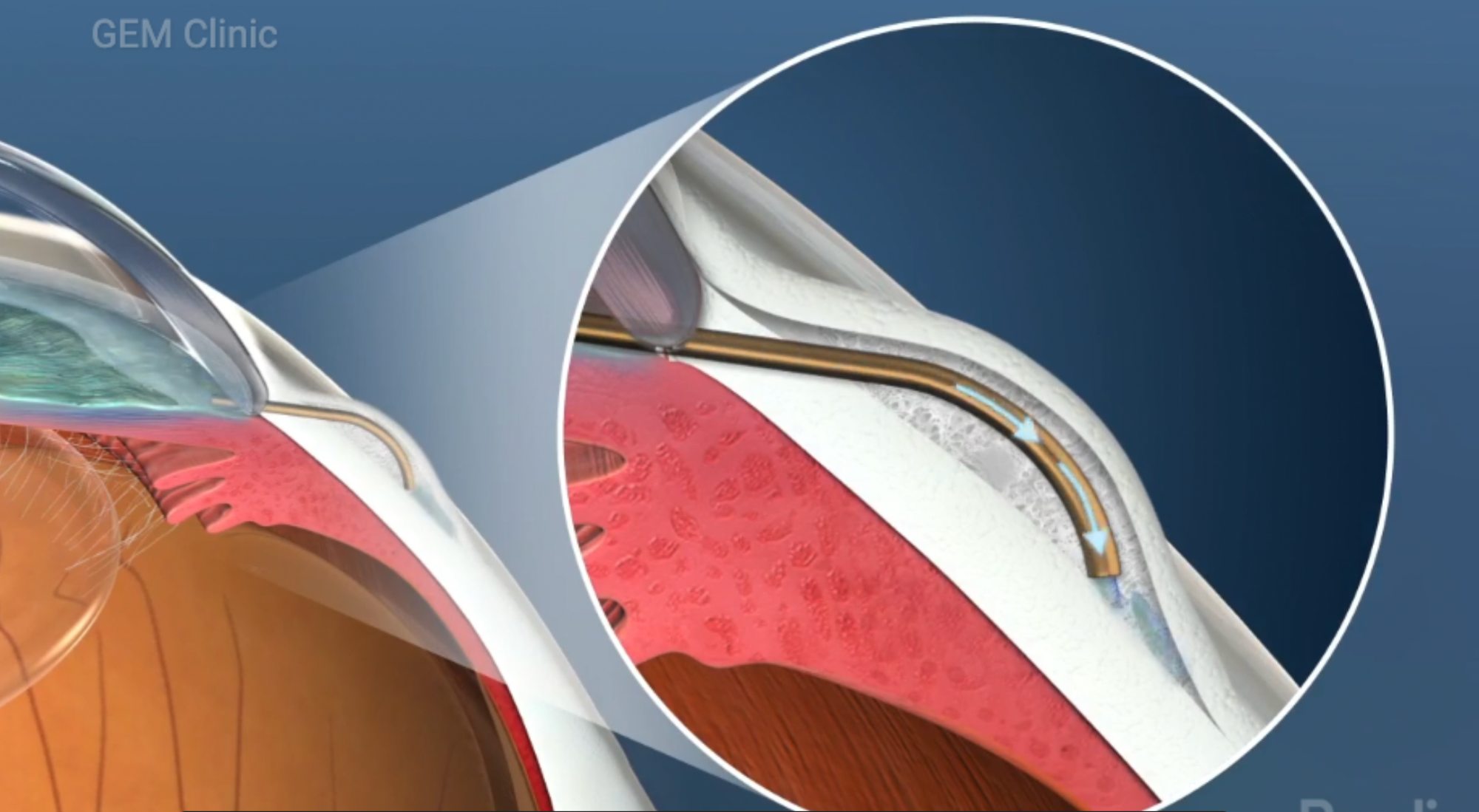 XEN Implant | GEM Clinic Medical Corporation